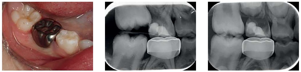 Come eseguire una pulpotomia sui denti decidui